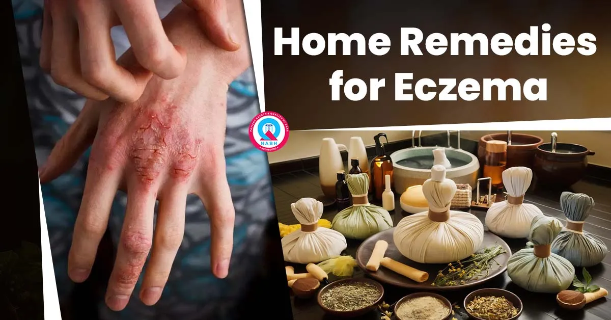 Home Remedies for Eczema - Natural & Easy Treatments