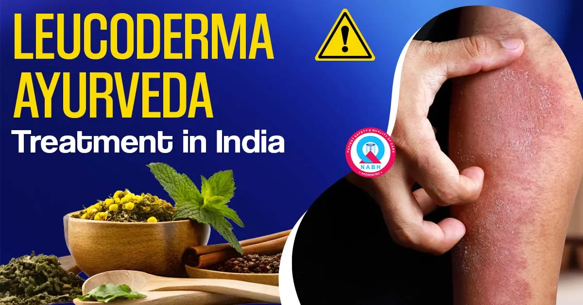 Leucoderma Ayurveda Treatment – Natural Ayurvedic Cure for Vitiligo